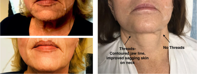 PDO Threads Services - Natural Skin Lifting in Littleton, CO